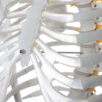 Hypermobility Rib Subluxation: A Practical Guide - The Fibro Guy